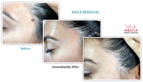Moles V Melanoma West La Medical And Skincare West La Medical And