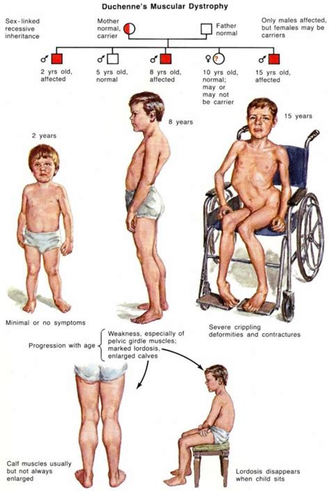 Himanshu Understanding Duchenne Muscular Dystrophy Dmd Duchenne