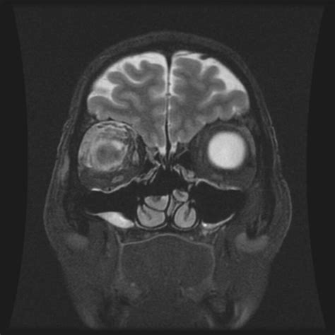 Radiopaedia Case Orbital Cellulitis Id 70170 Study 80210 Nc Commons