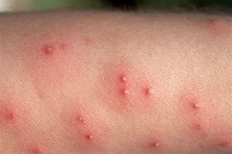 Ant Bites
