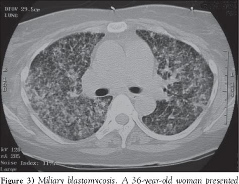 Figure 3 From Computed Tomographic Scan Evaluation Of Pulmonary
