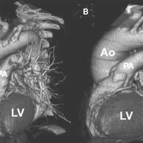 Bolus Tracking Technique The Geometry Of The Main Bolus Is Displayed