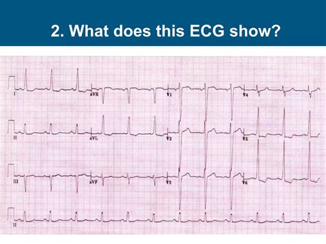 Ecg Interpretation Nstemi Pptx