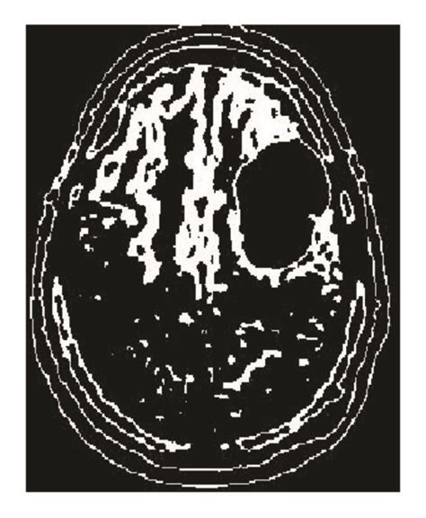 Segmented And Area Extracted Result Of Brain Mr Image A Original