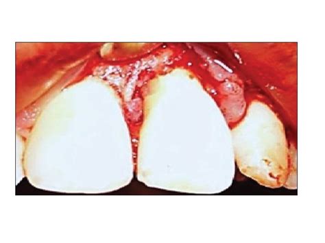 External Cervical Resorption Case Report And A Brief Review Of Literature Journal Of Natural