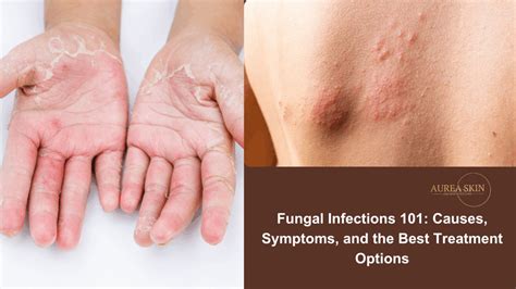 Fungal Infections 101 Causes Symptoms And The Best Treatment Options