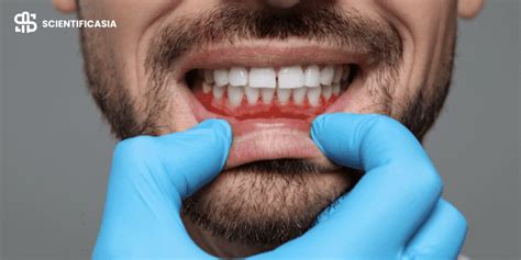 What Causes Staining On Teeth And Gums