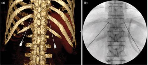 Complications Of Splanchnic And Celiac Plexus Block Anesthesia Key
