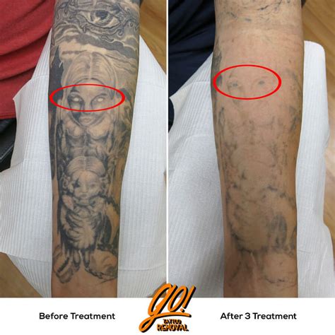 Tattoo Removal Ink