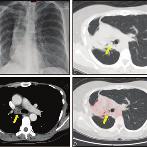 Pathological Evaluation The Polypoid Tumor Was Constituted By A