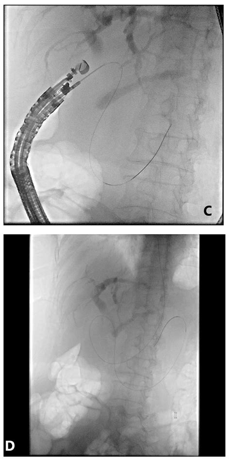 Troubleshooting Difficult Bile Duct Access Advanced Ercp Cannulation