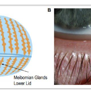 Meibomian Gland Dysfunction Signs Causes Gdxgq