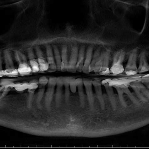 Pdf A Rare Case Of Phlebolith Detected By An Oral Radiologist