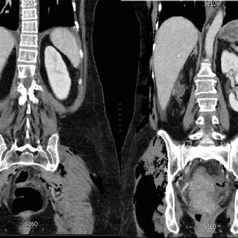 Ct Abdomen And Pelvis Showed Extensive Retroperitoneum And Subcutaneous