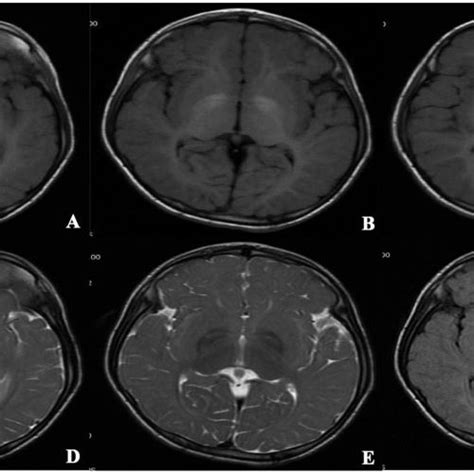 Maculopapular Rash On The Patient A C Punctiform Or Speckled Papules
