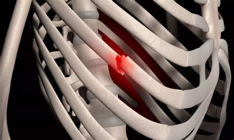 Early Ssrf Reduces Mortality And Improves Outcomes In Functionally Dependent Rib Fracture
