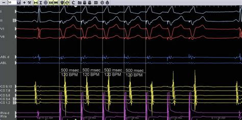Electrophysiology Study Interpretation Of Intracardiac
