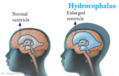 Hydrocephalus Types Causes Symptoms Diagnosis Treatment Health Tips