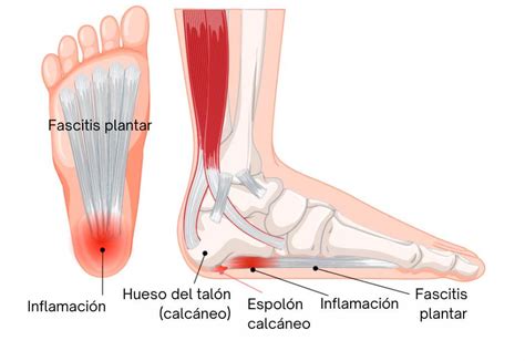 Espolón Calcáneo Causas Síntomas Y Tratamiento