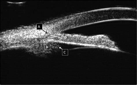 Plateau Iris And Severity Of Primary Angle Closure Glaucoma American