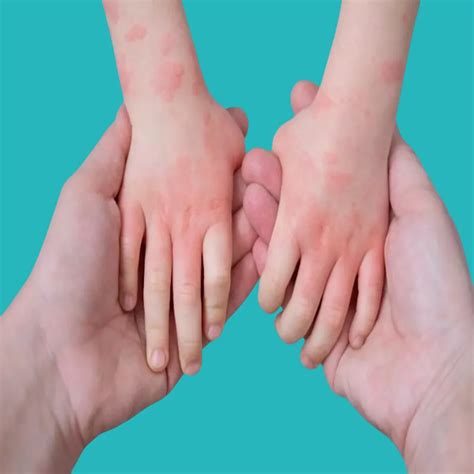 قرح في الفم عند الاطفال