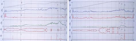 Voiding Dysfunction Abdominal Key