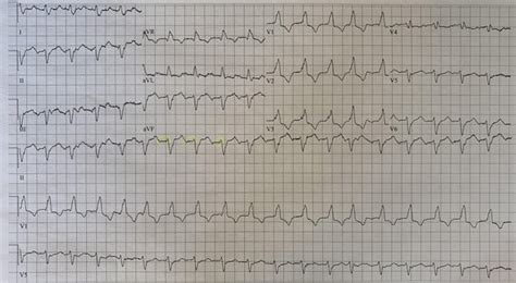 I See The Rbbb But Is There Also A Lpfb R Ecg