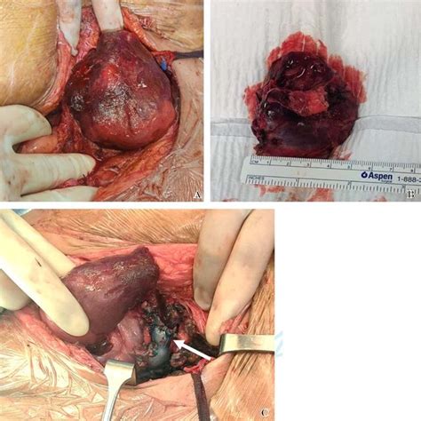 Intraoperative Photos A The Allograft Cut Surface After Removal Of