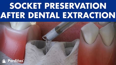 Normal Socket After Tooth Extraction
