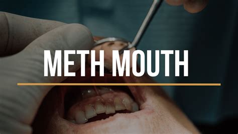 Understanding Meth Mouth The Dental Impact Of Methamphetamine
