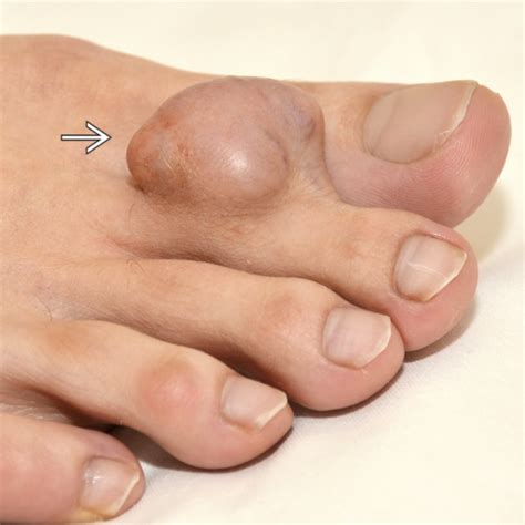 Dermatofibrossarcoma Protuberans Braco Câncer De Pele Dr