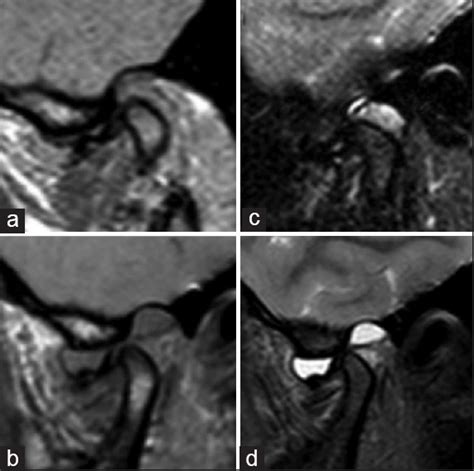 Early Magnetic Resonance Imaging Control After Temporomandibular Joint
