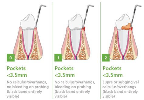 Classification Of Periodontal Disease Health And Plaque Induced Gingivitis Periodontology