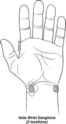 Ganglion Cysts Aberdeen Virtual Hand Clinic