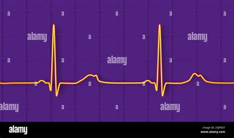 Notched T Wave Benign Early Repolarization Wikipedia