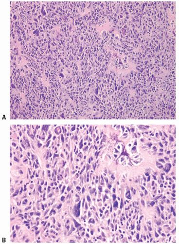 Osteosarcoma Histology