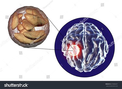 Brain Abscess 3d 204 Images Photos Et Images Vectorielles De Stock Shutterstock