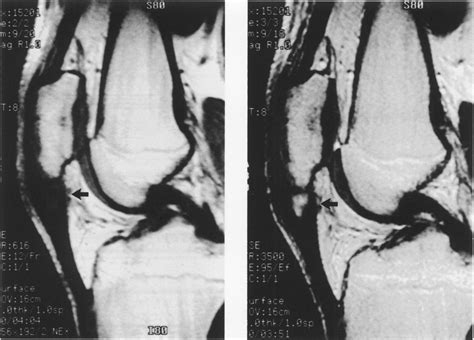 Mri Of Patellar Tendonitis A And B Ti Weighted Tr 616 Msec Te 12