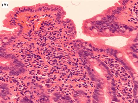 Chapter 14 Duodenitis Abdominal Key