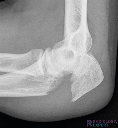 X Elbow