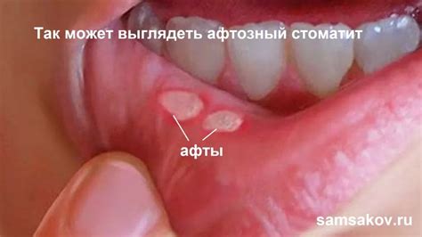 Афтозный стоматит симптомы причины и лечение Альянс бьюти