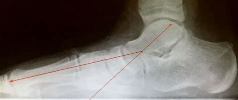 Cotton Osteotomy Robert Sheinberg Dpm Weston Fl Podiatrist