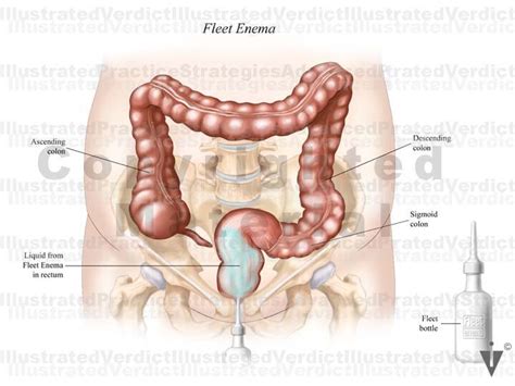 Stock Colon Rectum Enema — Illustrated Verdict