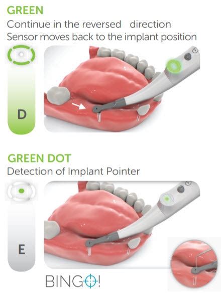 Spotter Smart Implant Detector Avtec Dental
