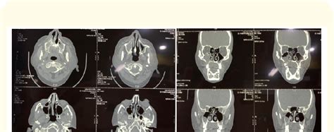 Ct Face Showing Axial And Coronal Views Download Scientific Diagram