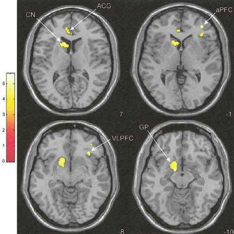 Left Greater Activation Of The Left Ventrolateral Prefrontal Cortex
