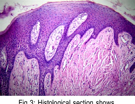 Gingival Hyperplasia Histology