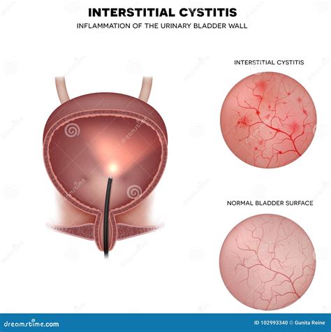 Urinary Bladder Lining Stock Vector Illustration Of Damage 102993340