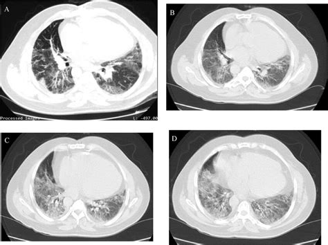 Showing Bilateral Infiltrations Of Different Radiological Patterns A