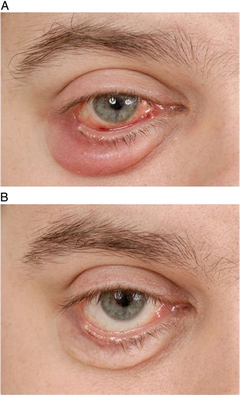 Madarosis Milphosis Eyelash Trichomegaly And Dermatochalasis